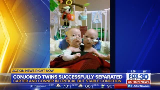 Conjoined twins Carter and Conner now separated | WJAX-TV