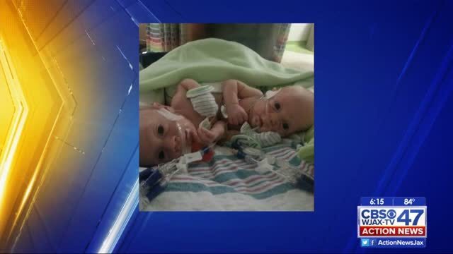 Conjoined twins Carter and Conner now separated | WJAX-TV